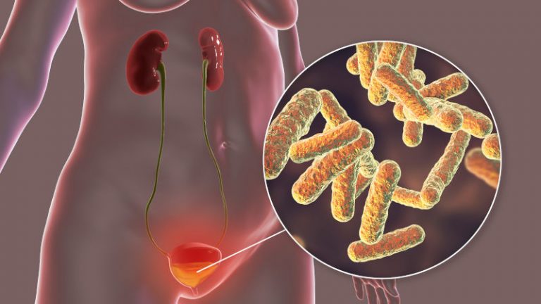 Cystitis | Symptoms, Diagnosis and Treatment