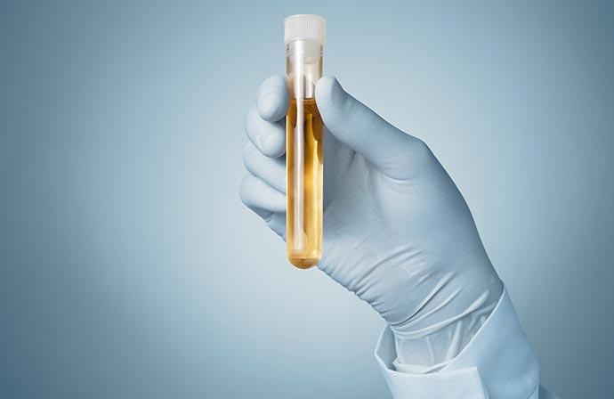 Urinalysis (Urine Tests) | The Urology Partnership